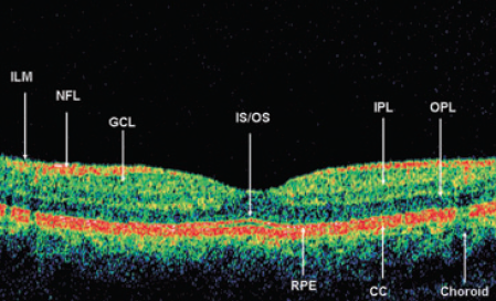 Optical Coherence Tomography – OCT – Norges Optikerforbund